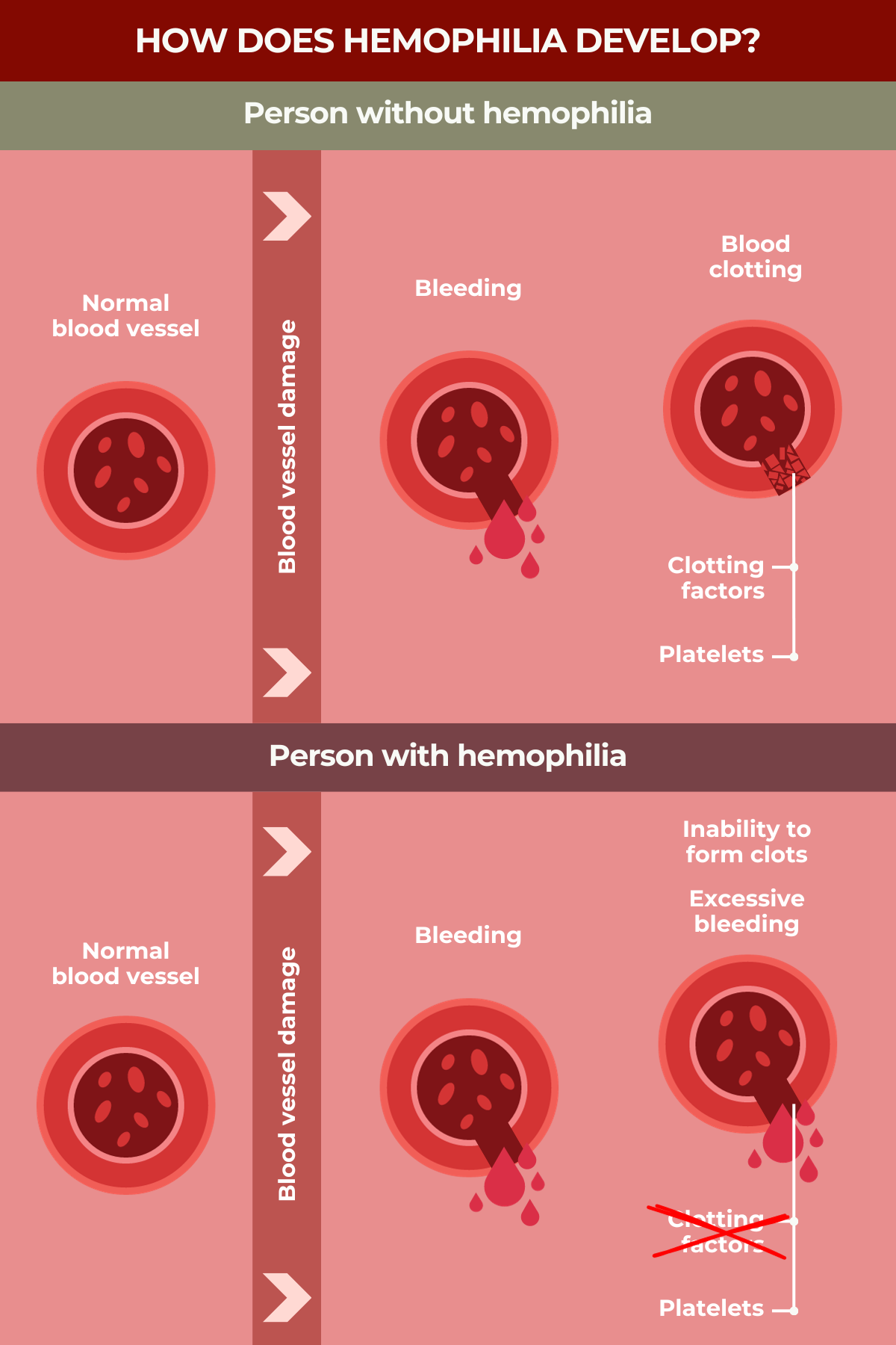 What Is Hemophilia Hemophilia News Today